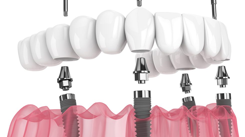 All on 4 and All on 6 - Dental implant installation methods | Dentelin