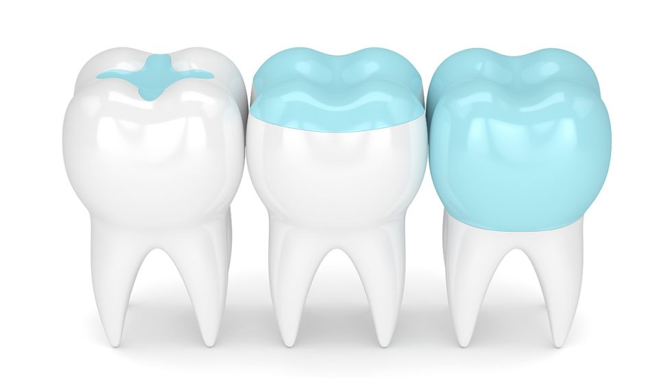 Inlay, Onlay & Overlay - Creating Dental Restorations